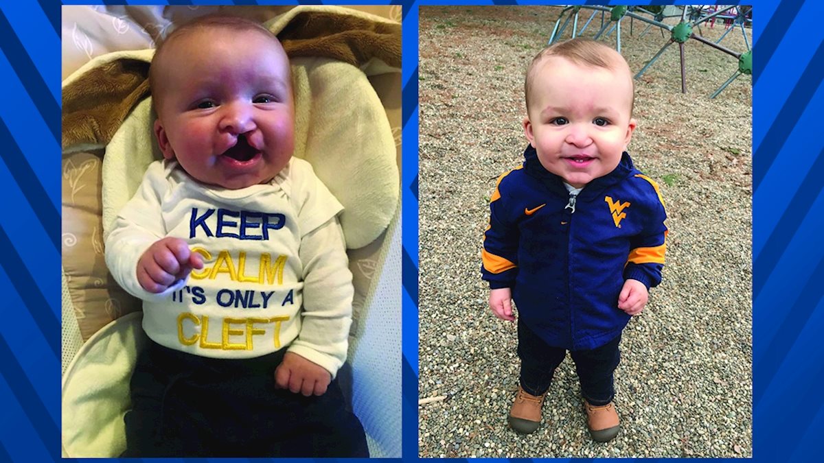 WVU Medicine Children’s Cleft Lip and Palate Team delivers smiles ...