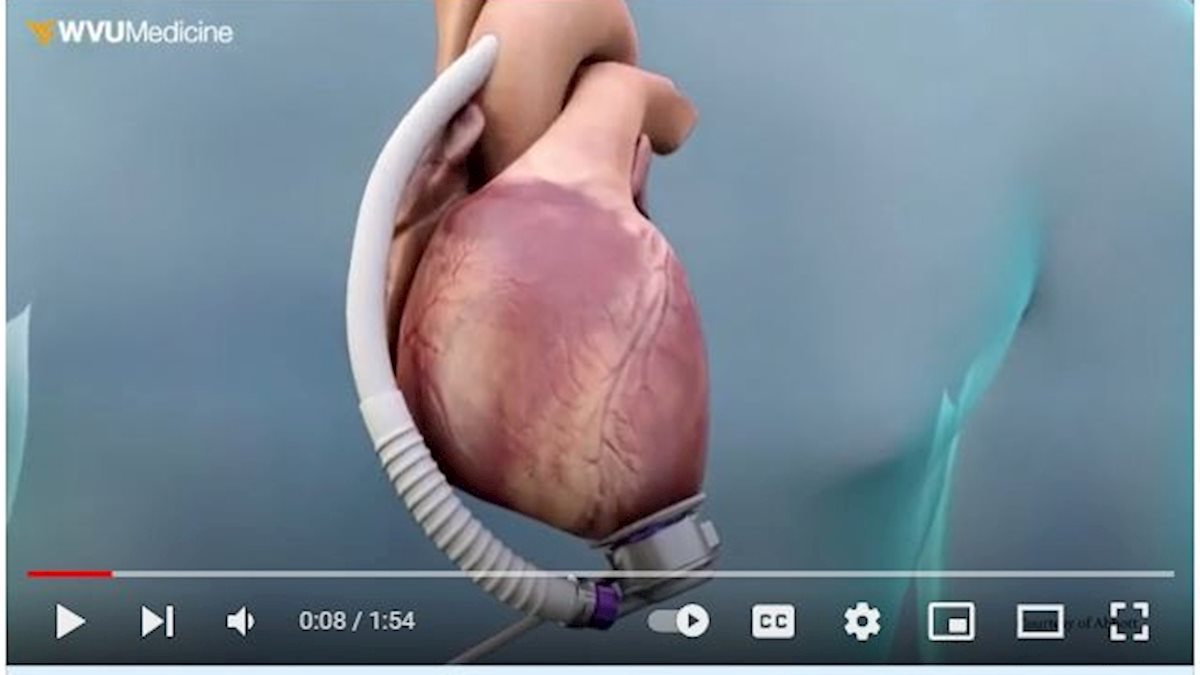 WVU Medicine Health Report - Left Ventricular Assist Device (LVAD ... WVU Medicine Health Report - Left Ventricular Assist Device (LVAD ...